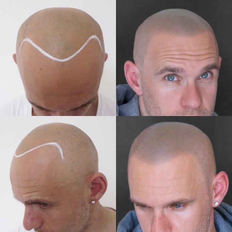 Scalp Transformation with Skalp - Skalp