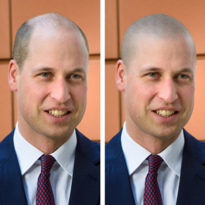 Prince William's Shaved Head | Bald And Proud | Skalp