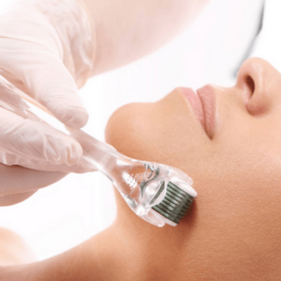 Micro Needling For Hair Loss | Does Micro Needling Work? | Skalp