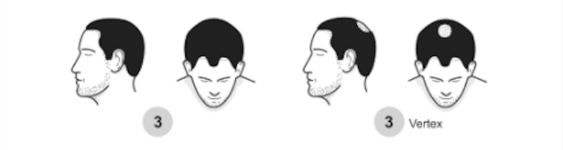 The 7 Stages Of Male Pattern Baldness Explained - Skalp