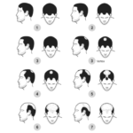 The 7 Stages Of Male Pattern Baldness Explained - Skalp