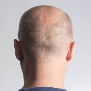4 Ways To Know If You Are Going Bald - Hair Loss In Men - Skalp