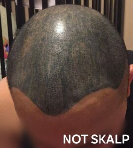 Scalp Micropigmentation Gone Wrong | Skalp