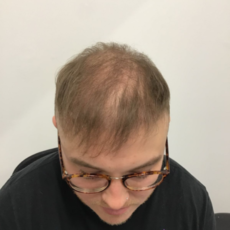 Hair Care Innovations for Fuller-Looking Hair - Skalp